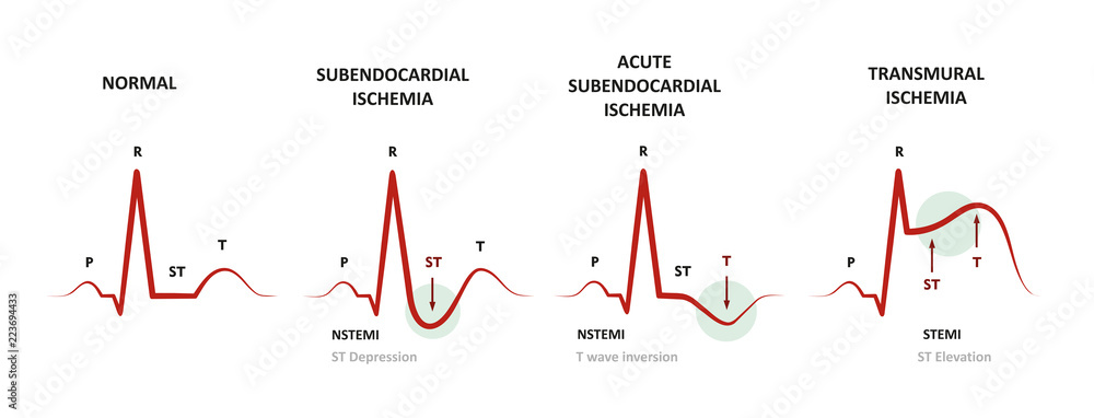 Diagnosis of Myocardial Ischemia (NSTEMI, STEMI) EKG of subendocardial ...
