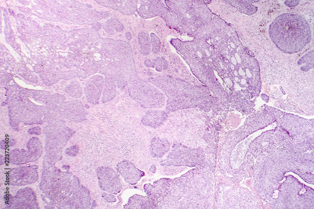 Foto de Stock Basal cell carcinoma, skin cancer, light micrograph ...