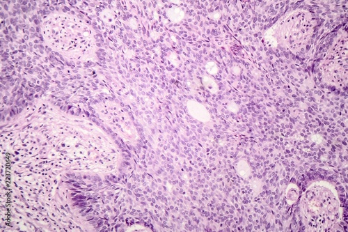 Basal cell carcinoma, skin cancer, light micrograph, photo under ...