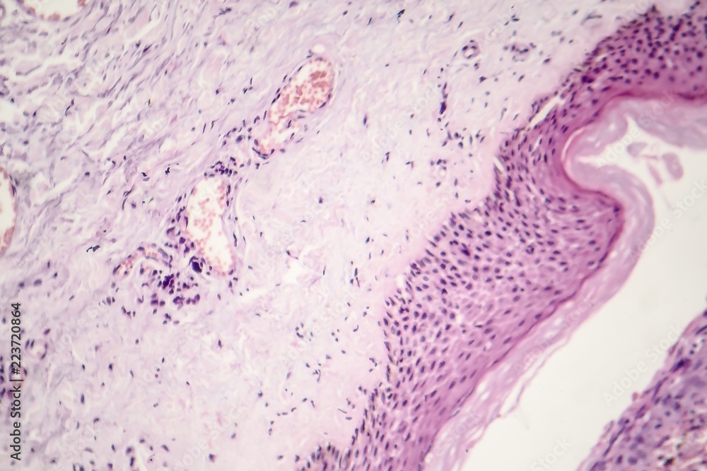 Basal cell carcinoma, skin cancer, light micrograph, photo under ...