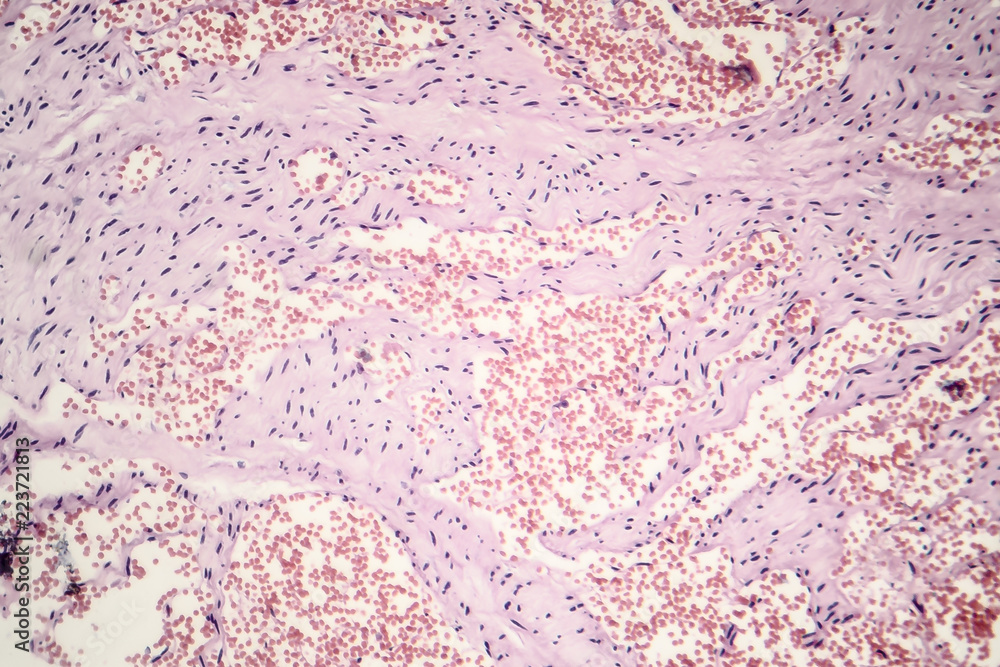 Capillary hemangioma, light micrograph, photo under microscope Stock ...