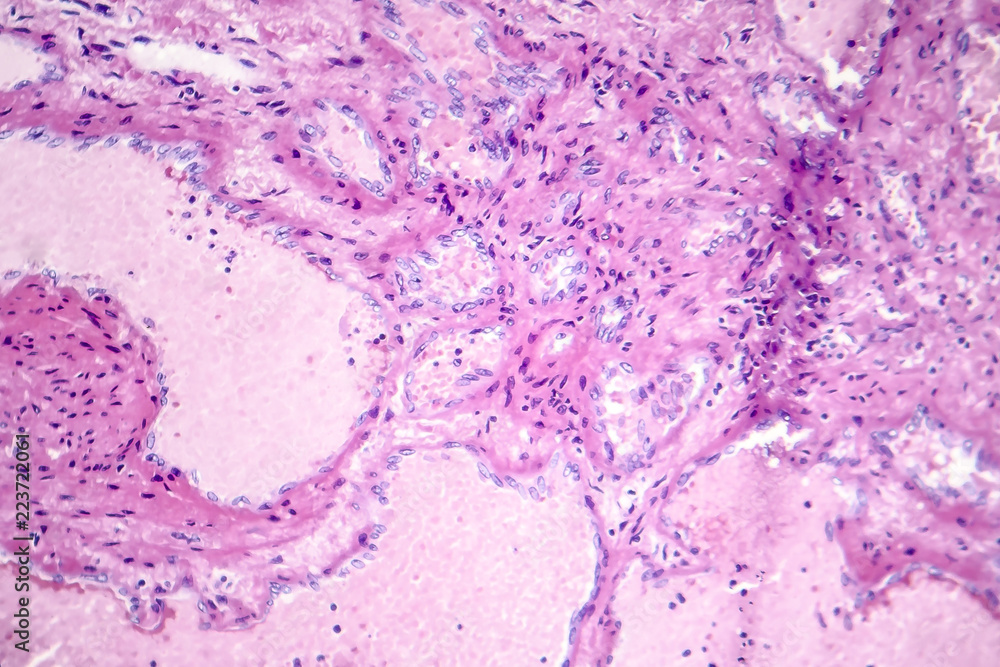 Hepatic cavernous hemangioma, a benign liver tumor, light micrograph ...