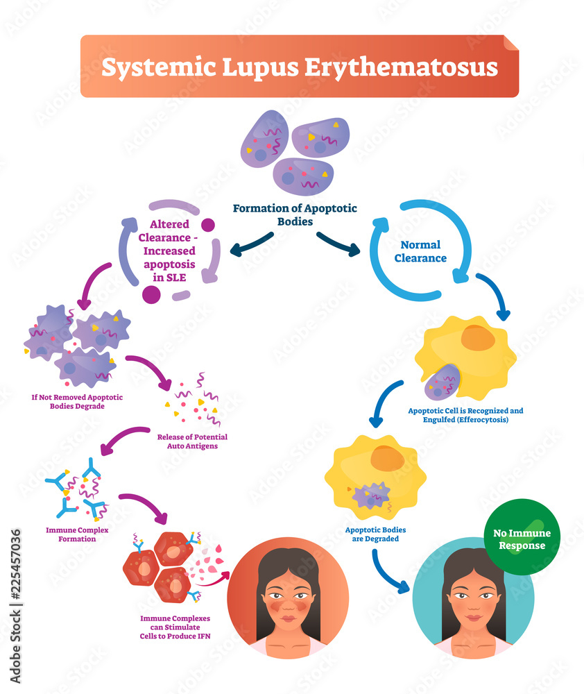 Systemic lupus erythematosus labeled diagram with normal and sick ...