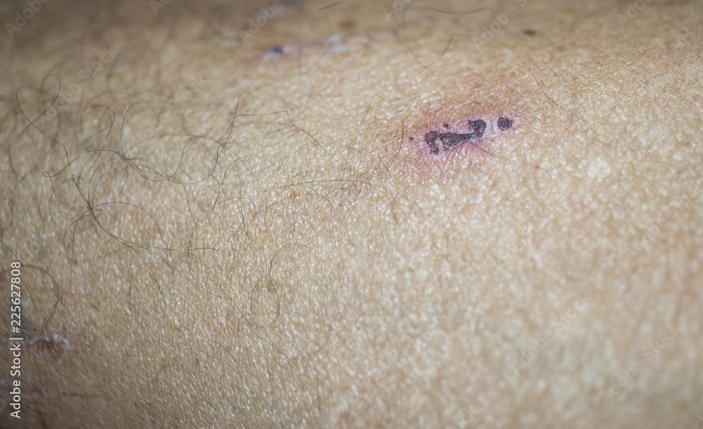 Scars are scabs, skin lesions. Stock Photo | Adobe Stock