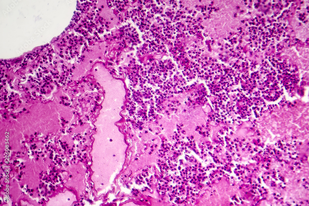 Lobar pneumonia, hemorrhagic edema period, light micrograph, photo ...