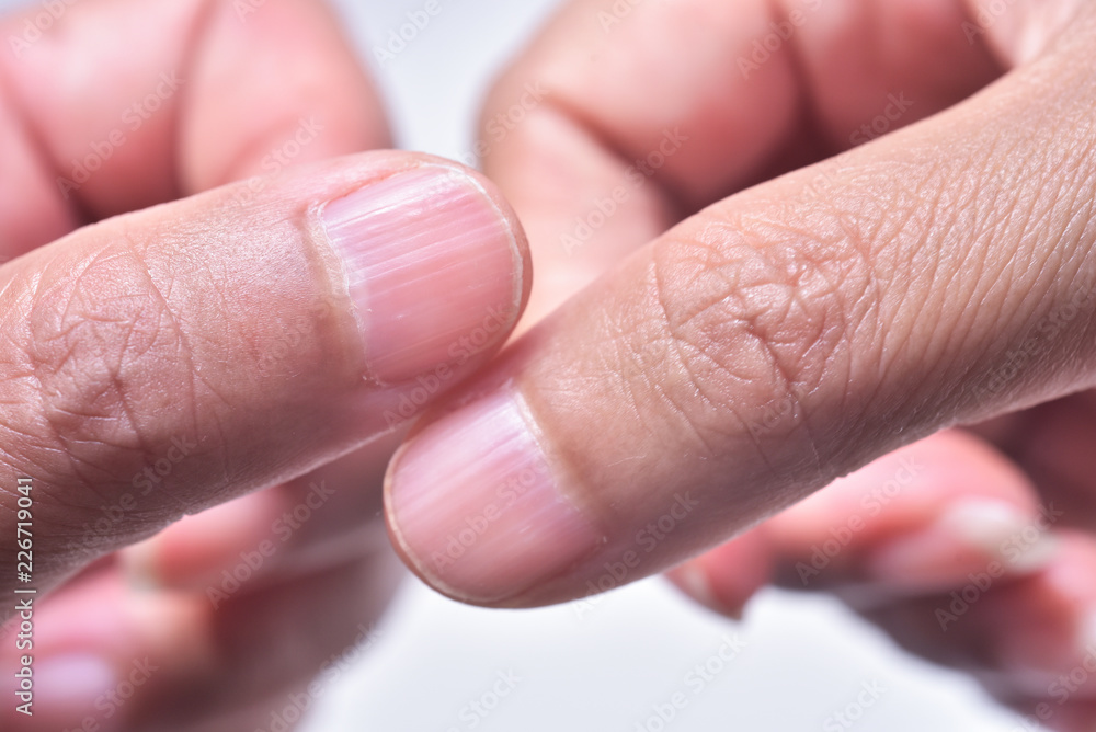 Stock-Foto „Longitudinal ridging nail. ( vertical nail ridges). The ...