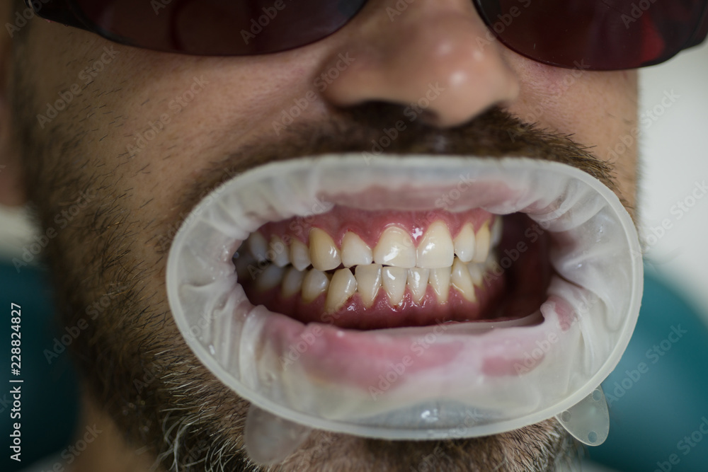Bleaching of the teeth at dentist clinic. Administer anesthetics to ...
