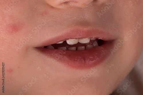 dry lips of a sick child. children and health. dry skin the baby is ill ...