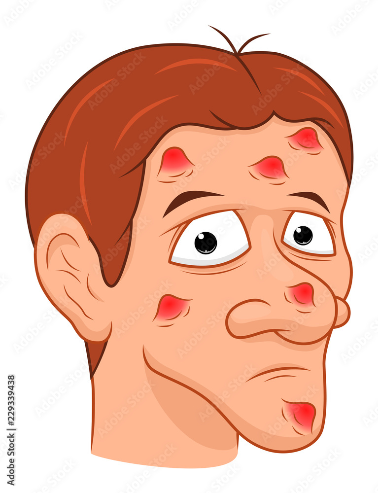 Cartoon man with acne Stock Vector | Adobe Stock