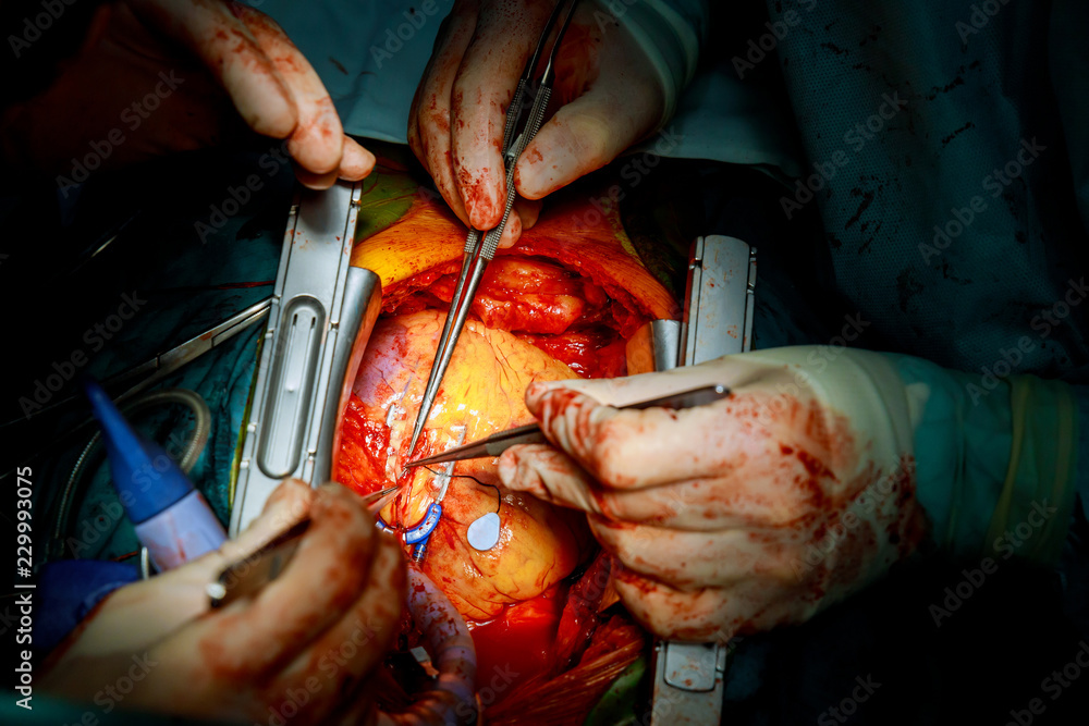 ภาพถ่าย Stock Heart surgery. Open heart surgery suture greater ...