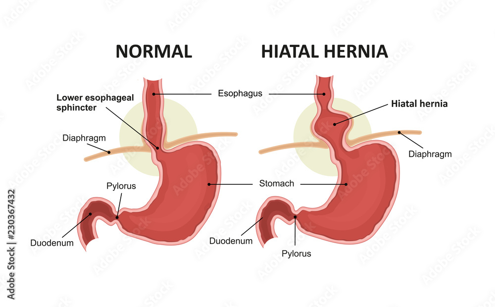 Hiatal hernia and normal anatomy of the stomach Stock Vector | Adobe Stock