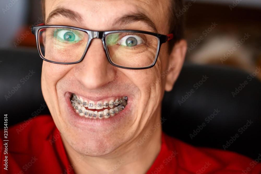 Crazy face of guy with braces on his teeth with smile and glasses ...