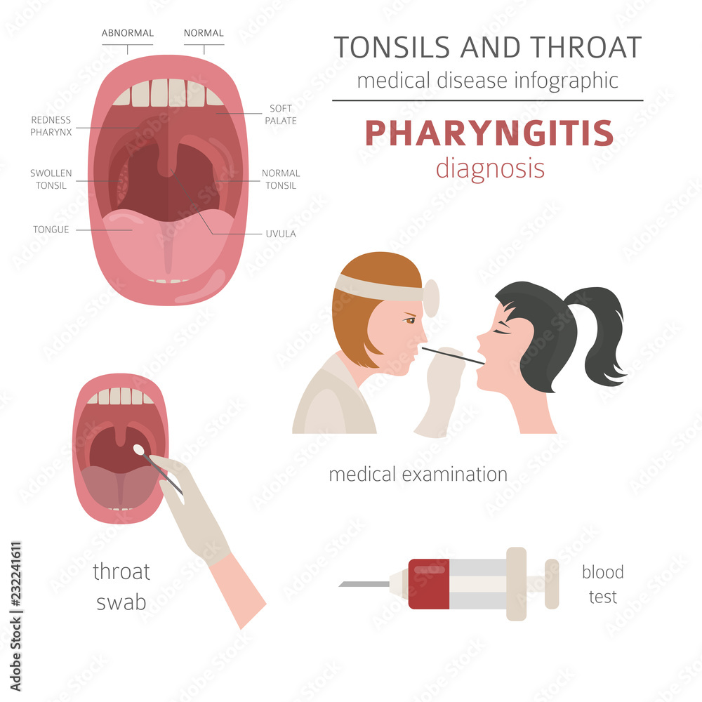 Vector de Stock Tonsils and throat diseases. Pharyngitis symptoms ...