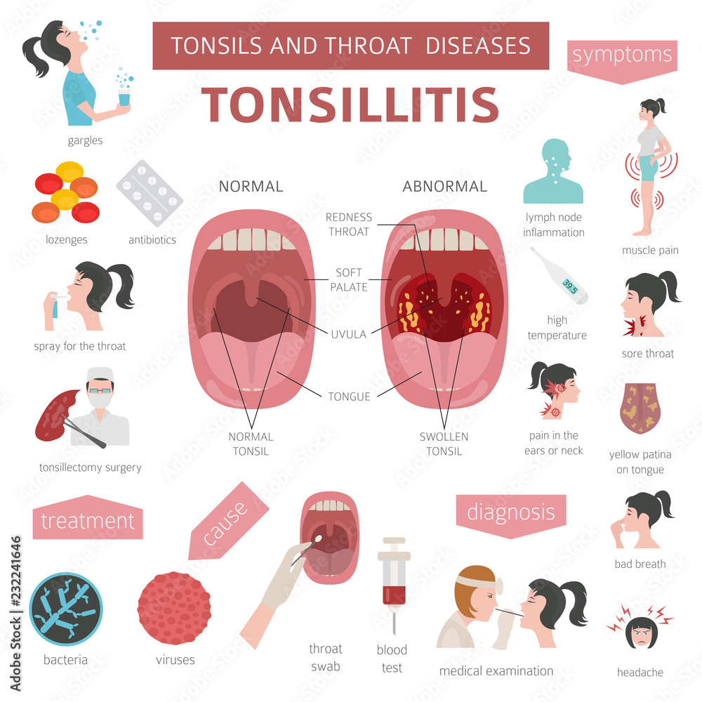 Tonsils and throat diseases. Tonsillitis symptoms, treatment icon set ...