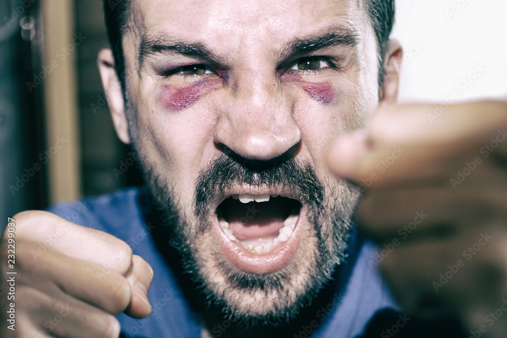 Man's face after the fight and assault. Caucasian male Emotional ...