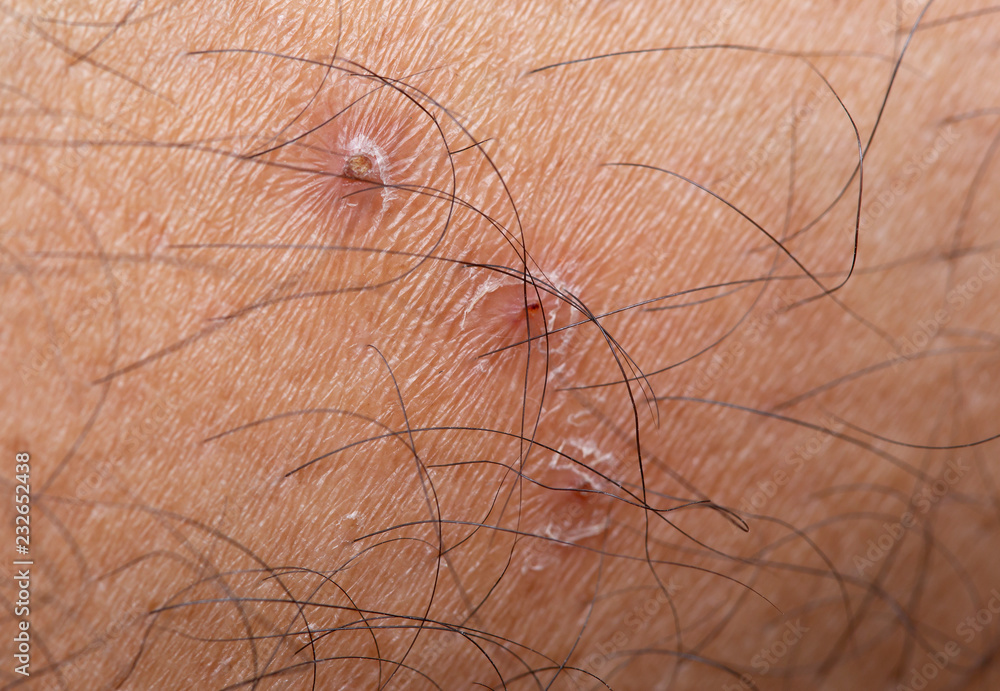 Stock-Foto „Wound infection on the skin, Skin lesions, Impetigo ...