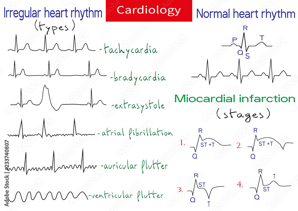 Normal and pathological ecg collection. Stock Vector | Adobe Stock