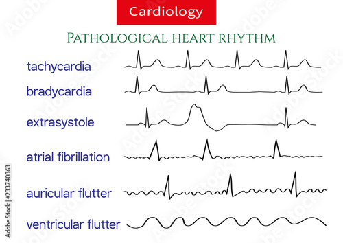 Pathological ecg collection. Stock Vector | Adobe Stock