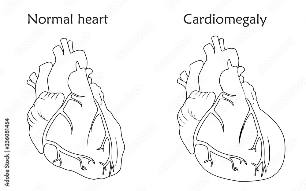 Cardiomegaly Diagram