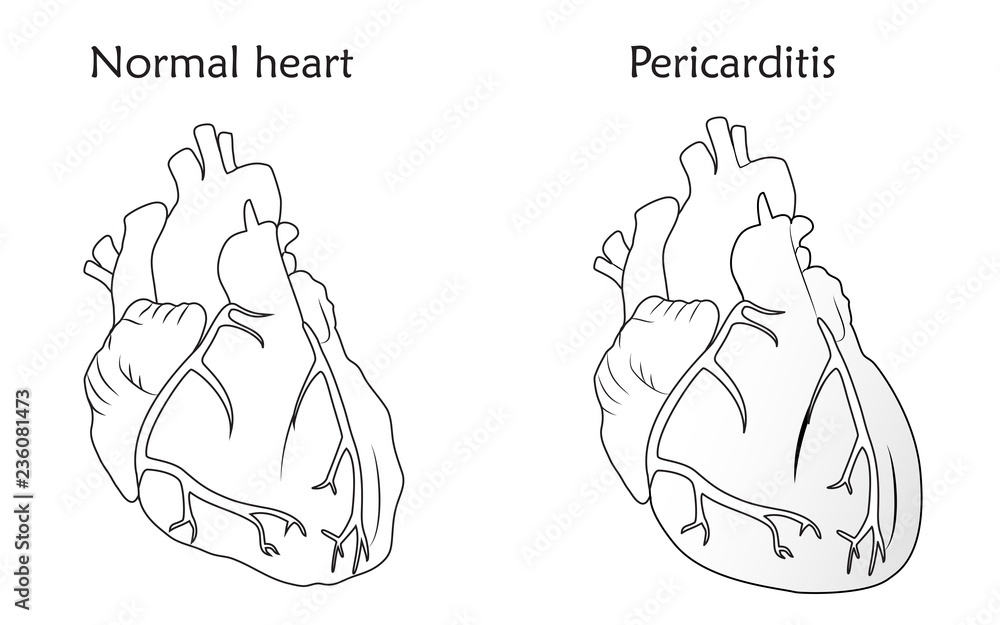 Pericarditis. Inflammation of the pericardium. Damaged and normal heart ...