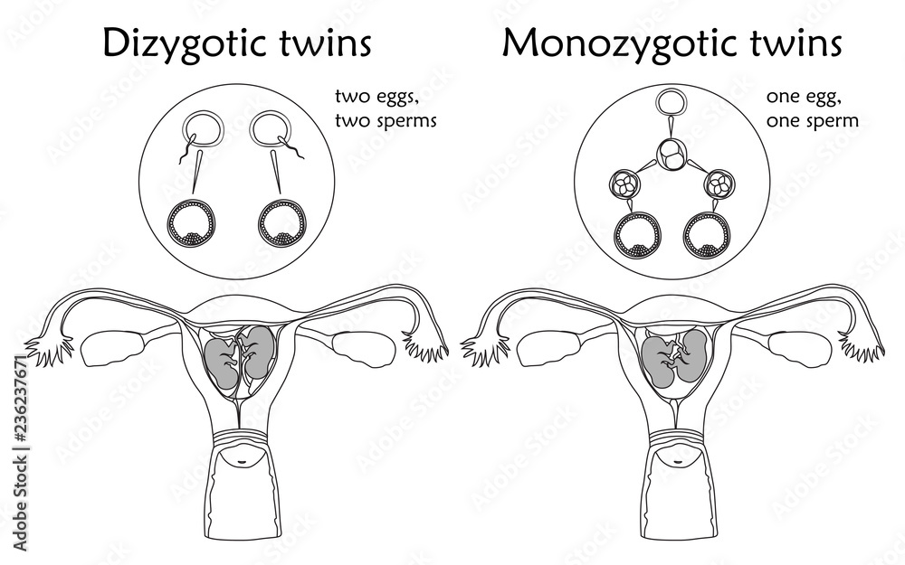 Image vectorielle Stock Multiple pregnancy. Dizygotic and monozygotic ...