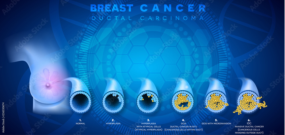 Breast cancer Ductal cancer stages background. Ductal carcinoma of the ...