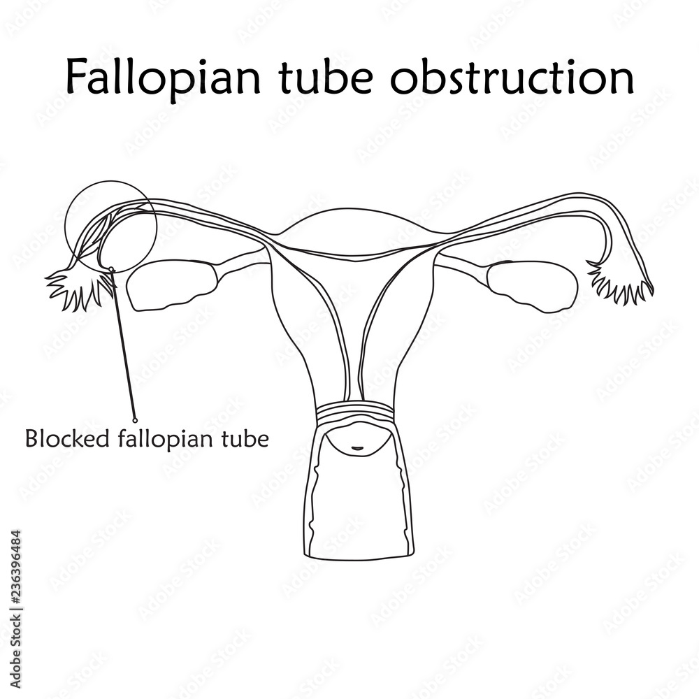 Fallopian tube obstruction. Human realistic uterus. Anatomy flat ...