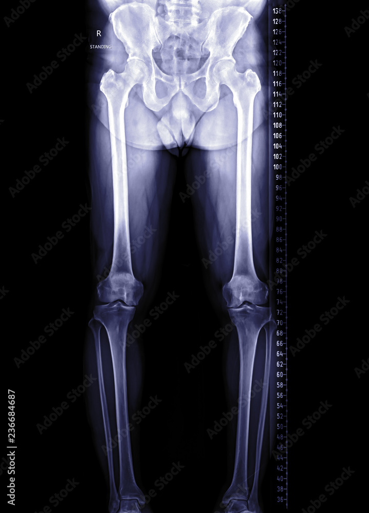 scanogram of lower limb or X-ray image of total lower extremity ...
