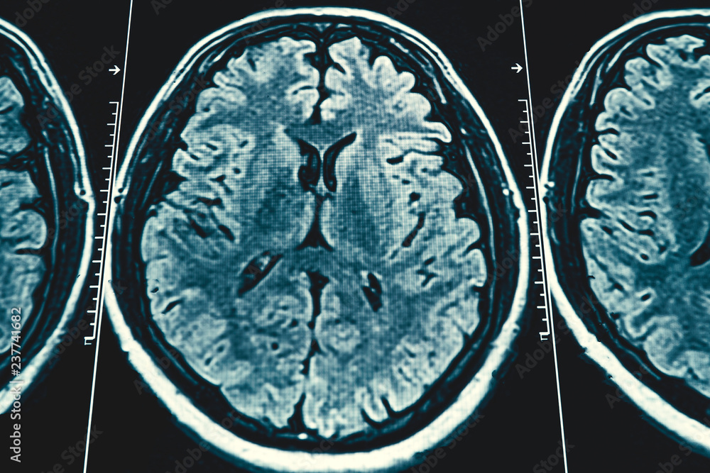 X-Ray or MRI brain scan background, magnetic resonance tomography image ...