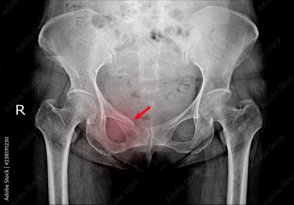 Hip x-ray Fracture right superior pubic ramus.Normal both hips. Stock ...