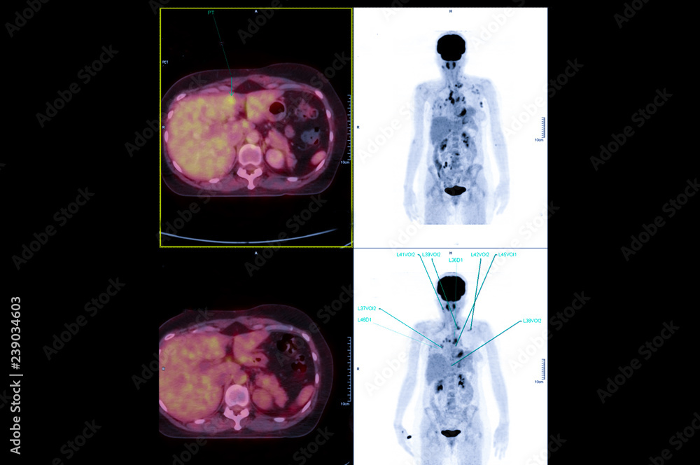 PET Scan image of whole body Comparision Axial , Coronal plane in patient Liver cancer ...