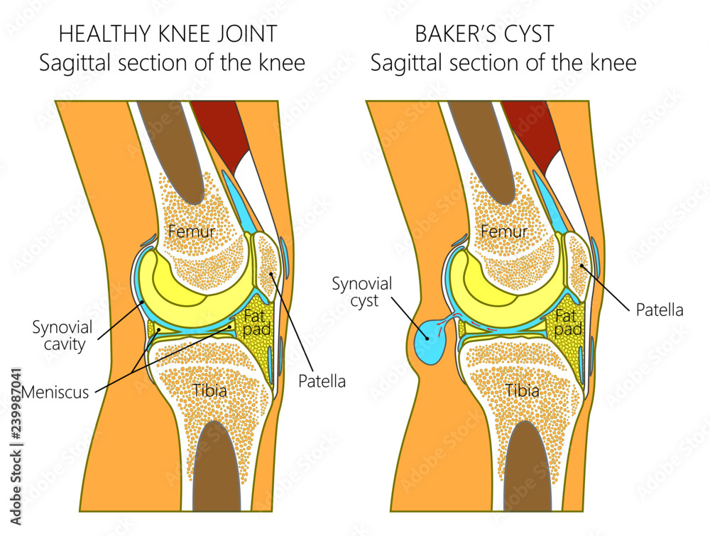 Vector de Stock Vector illustration of a healthy human knee joint and ...