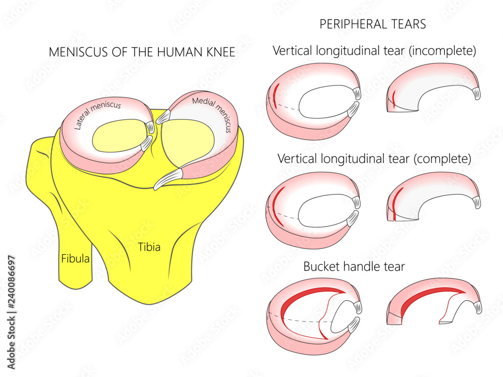 Image vectorielle Stock Vector illustration. Anatomy of a meniscus in ...