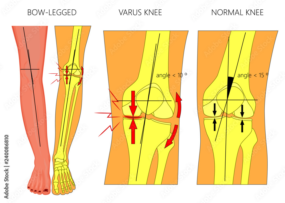 Vector illustration diagram. Shapes of human legs. Normal and curved ...