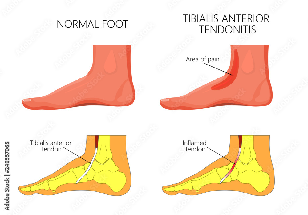Vector illustration of healthy human foot and a medial ankle injury ...