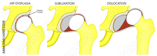 Vector illustration anatomy of a hip joint with dysplasia, subluxation ...