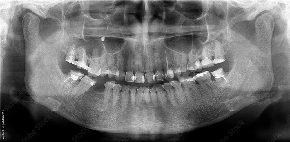Panoramic radiograph is a panoramic scanning dental X-ray of the upper ...