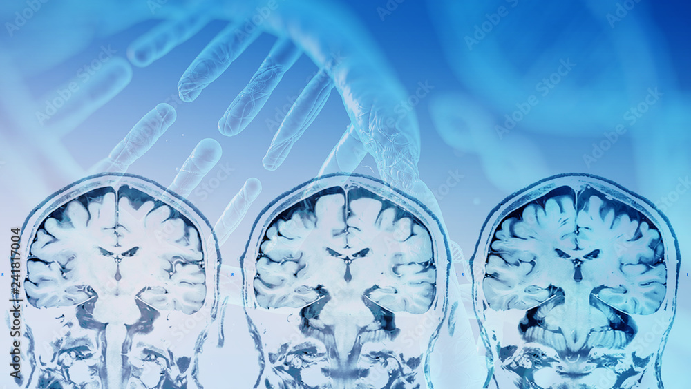 magnetic resonance image (MRI) of the brain overlay with DNA strain ...