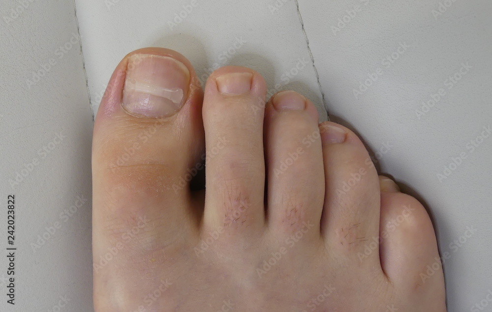 Ingrown toenail, toenail clamp Stock Photo | Adobe Stock