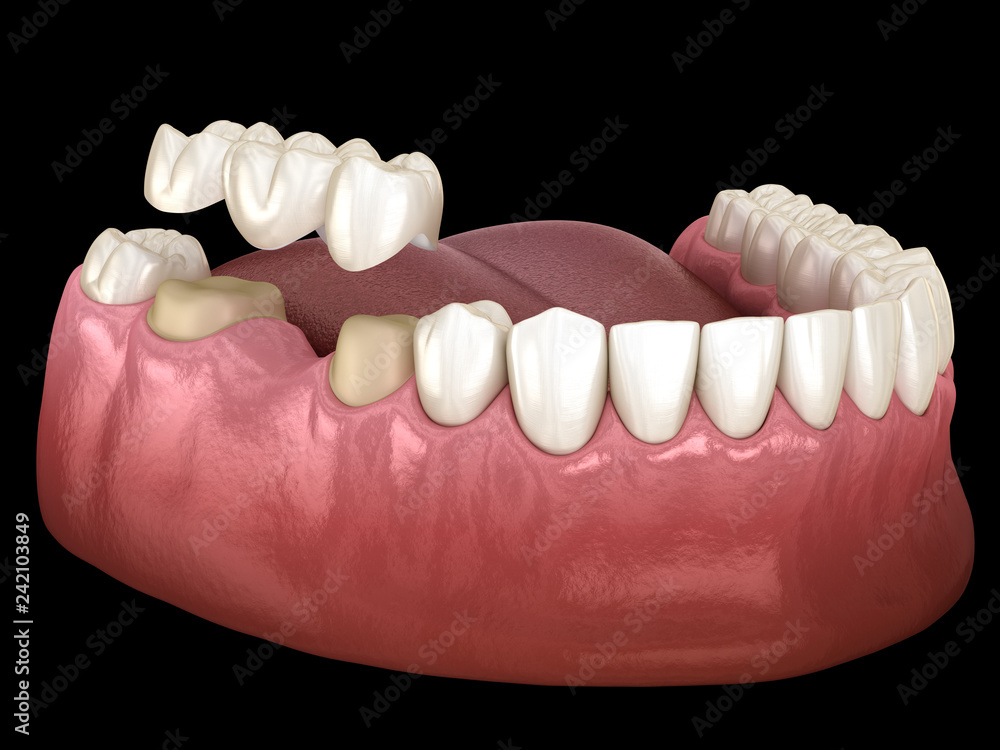 Dental bridge of 3 teeth over molar and premolar. Medically accurate 3D ...
