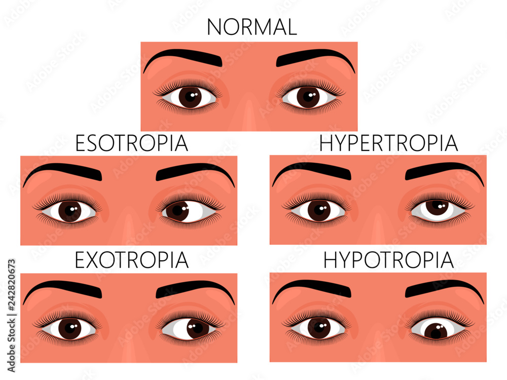 Vector illustration of normal human eyes and eyes with problem ...
