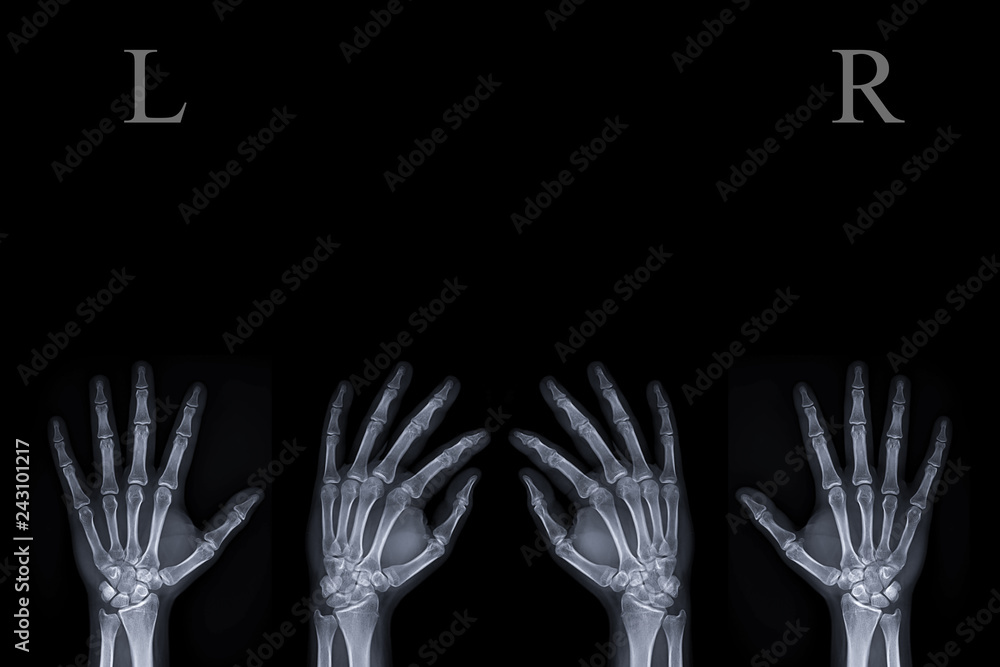Film X-ray both hand AP and oblique view . background and copyspace ...