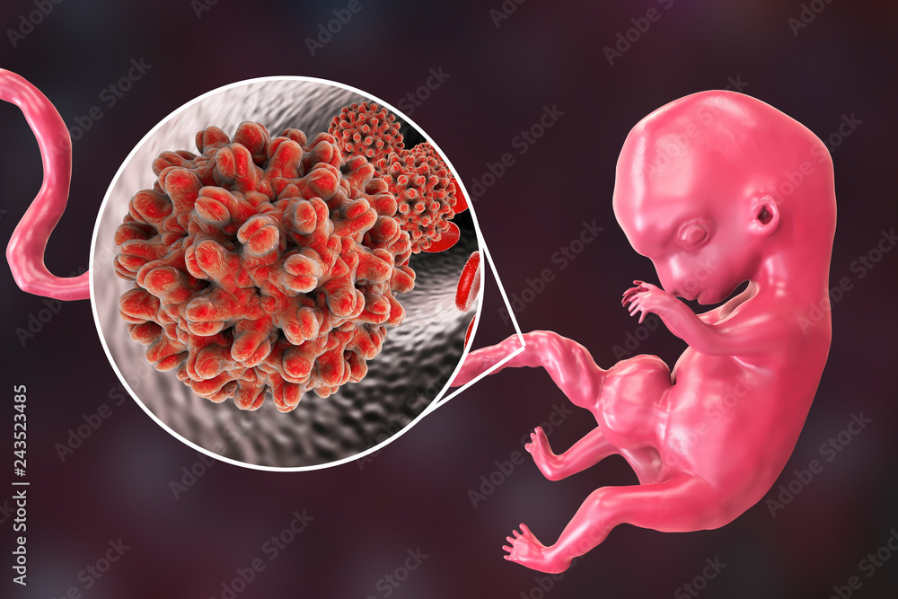 Stock-Illustration „Transplacental transmission of Hepatitis B viruses ...