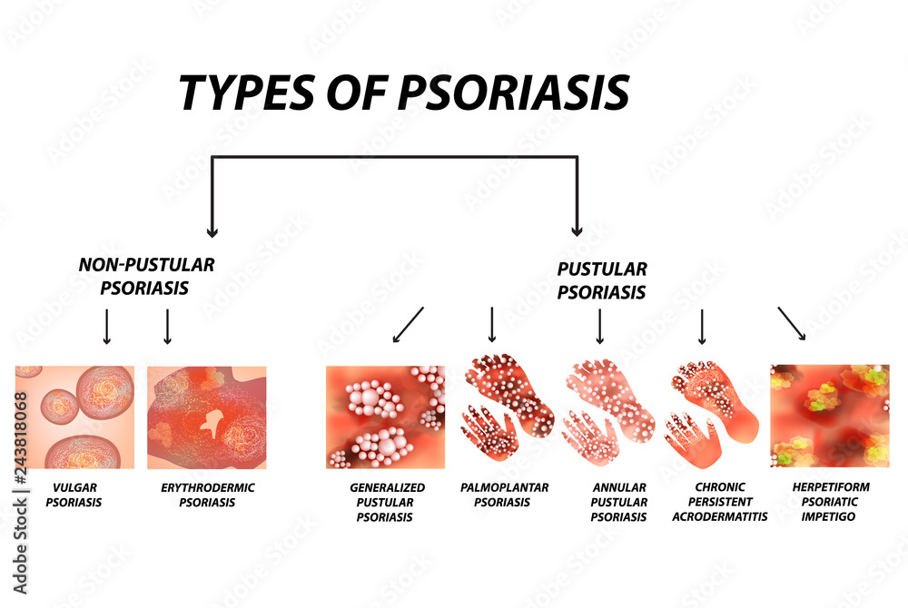 Types of psoriasis. Pustular and not pustular. Vulgar, erythroderma ...