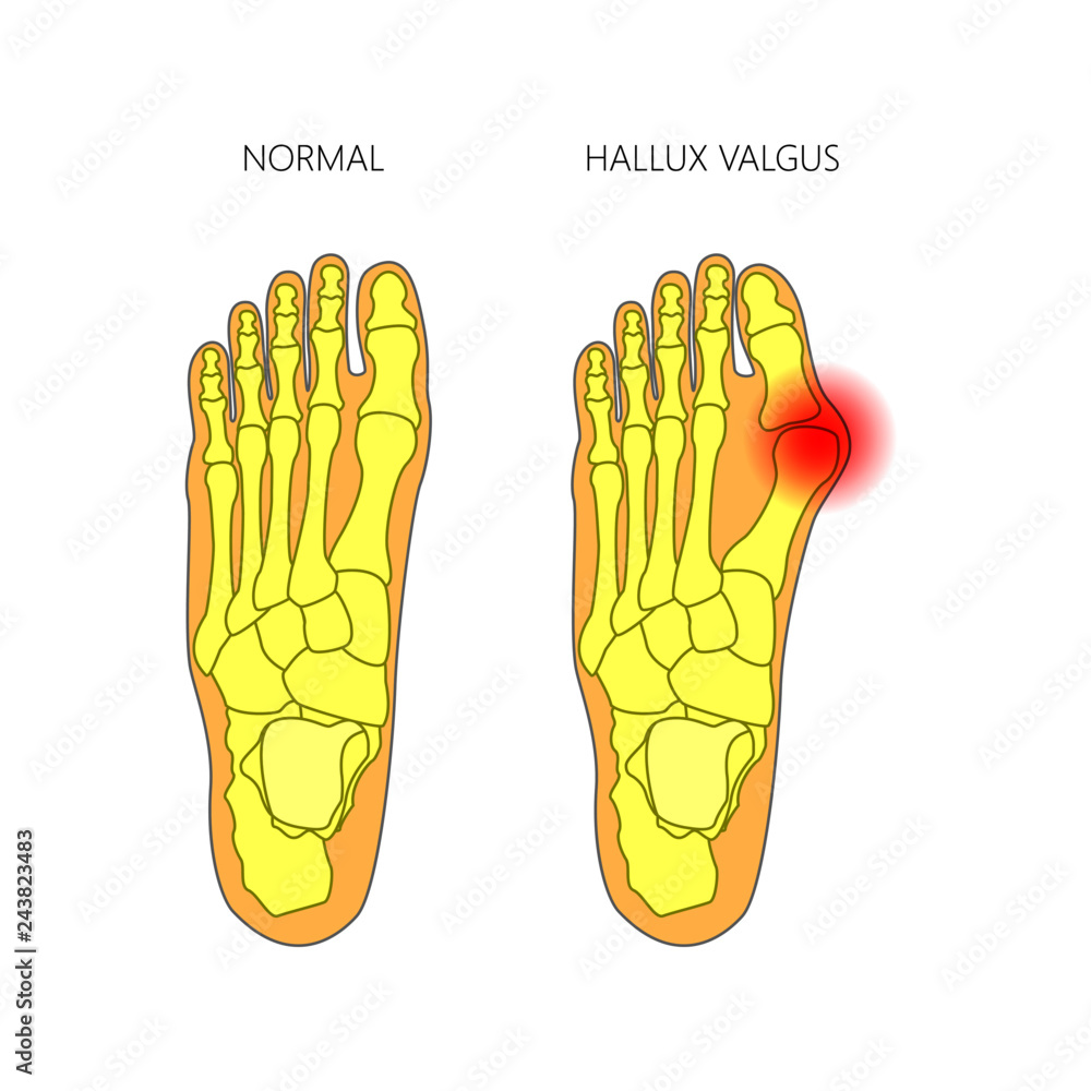 Illustration of the normal foot and valgus deviation of the first toe ...