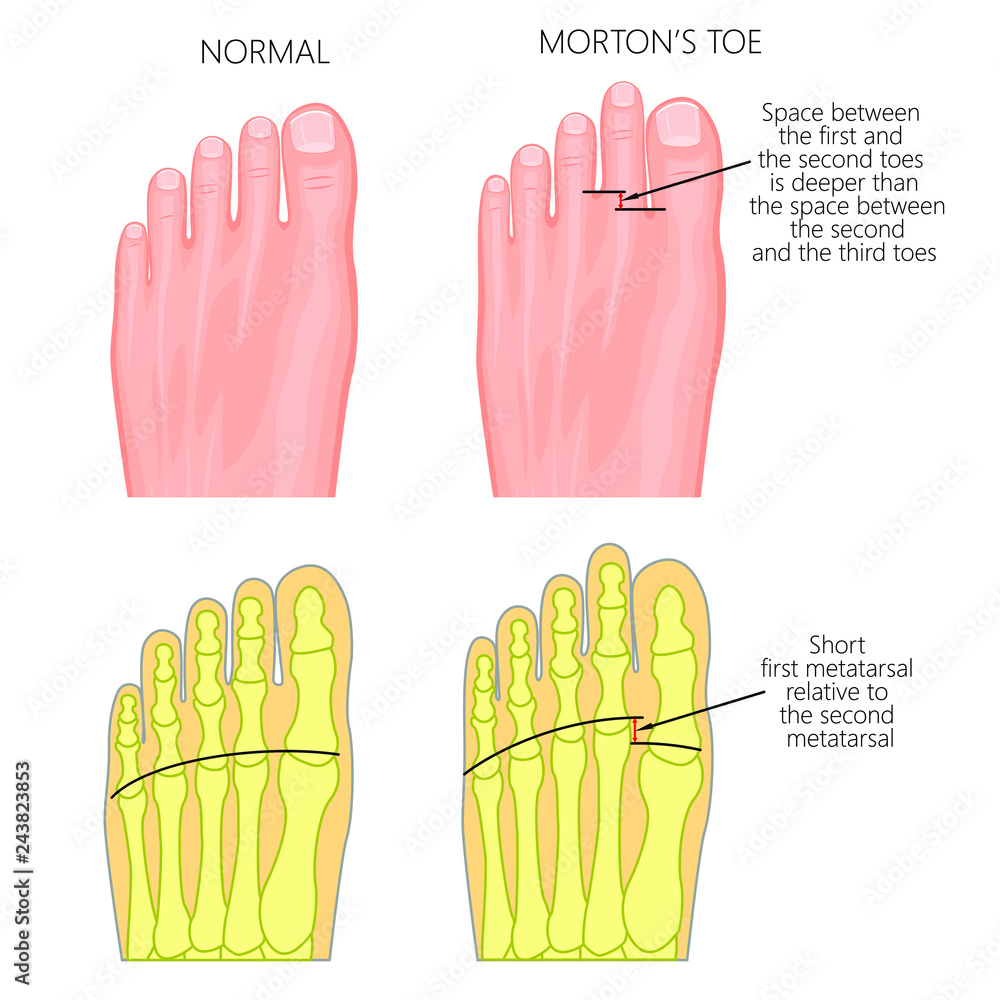 Morton foot store