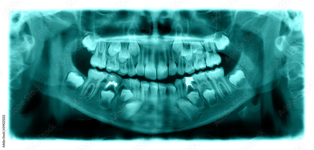 Panoramic radiograph is a scanning dental X-ray of the upper jaw ...