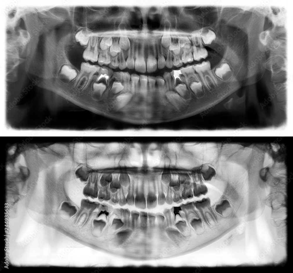 Panoramic radiograph is a scanning dental X-ray of the upper jaw ...