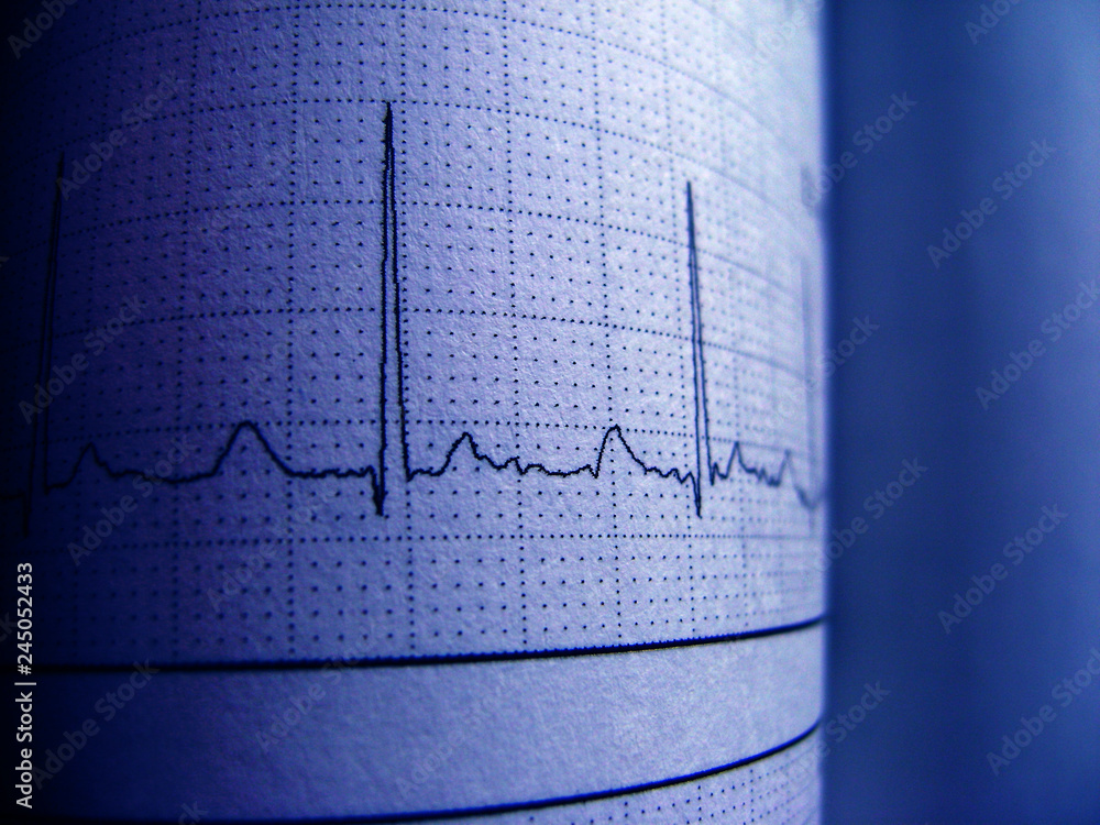 Sinus Heart Rhythm On Electrocardiogram Record Paper Showing Normal P Wave, PR and QT Interval ...