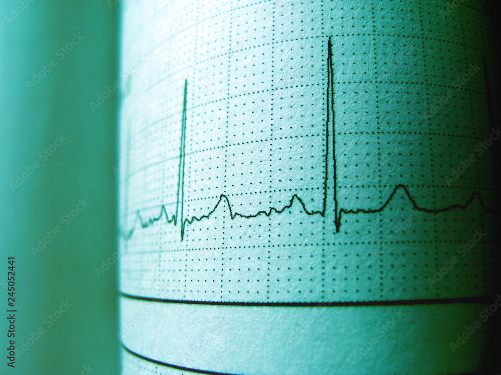 Sinus Heart Rhythm On Electrocardiogram Record Paper Showing Normal P ...